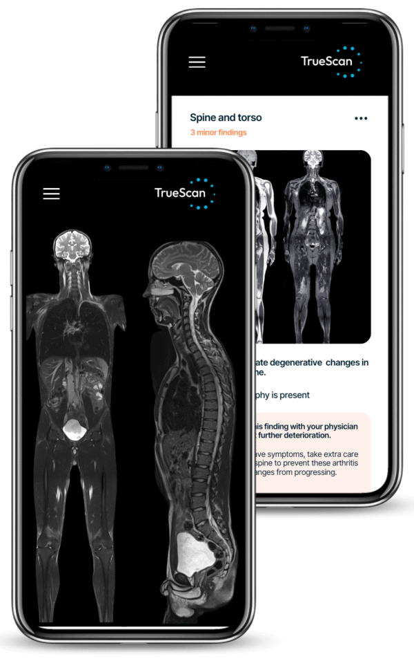 Full-Body MRI: Early Detection & Preventive Health Tool